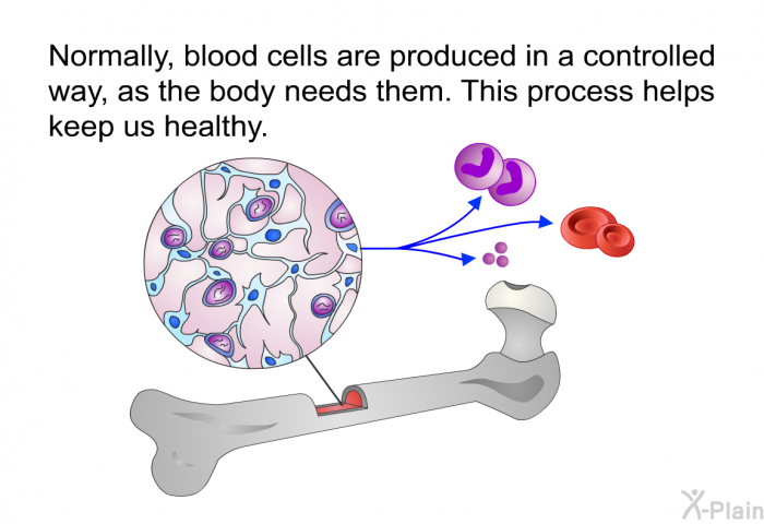 PatEdu.com : Acute Lymphocytic Leukemia - ALL