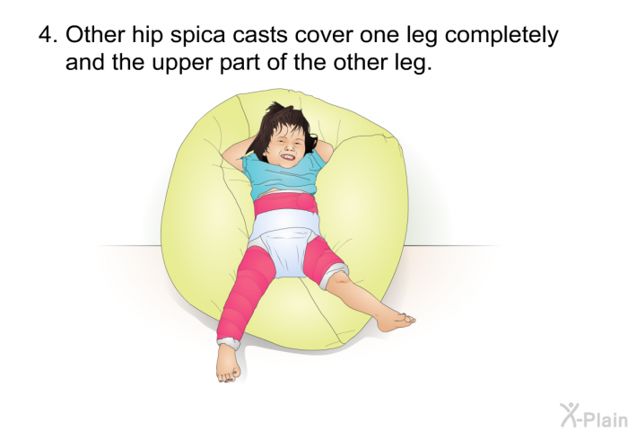 PatEdu.com : Hip Spica Cast