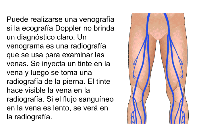 PatEdu.com : Trombosis venosa profunda