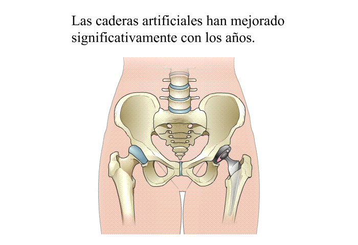 PatEdu.com : Reemplazo de cadera y Fisioterapia