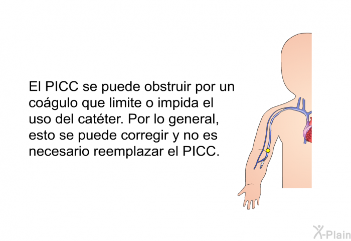 PatEdu.com : Catéter central de inserción periférica (PICC) - Pediatría
