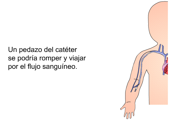 PatEdu.com : Catéter central de inserción periférica (PICC) - Pediatría