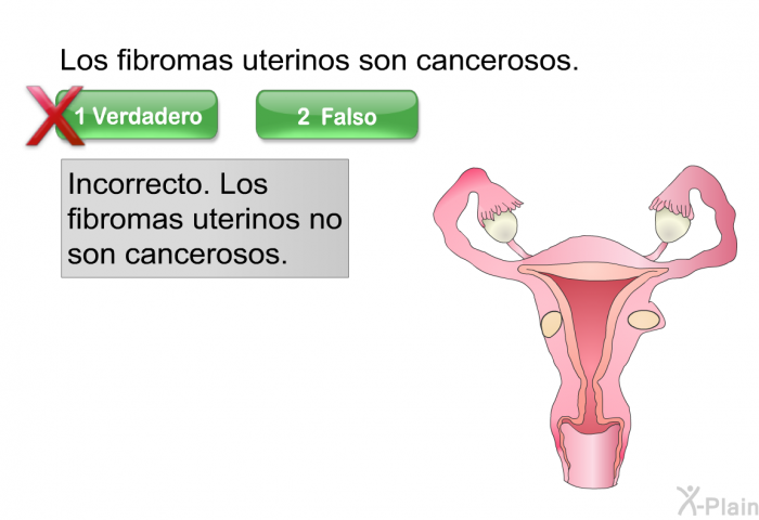 PatEdu.com : Fibromas uterinos